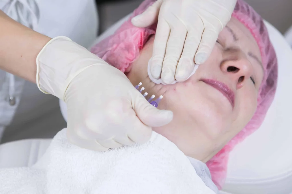 PDO Thread Lifts | Benefits And Risks Explained